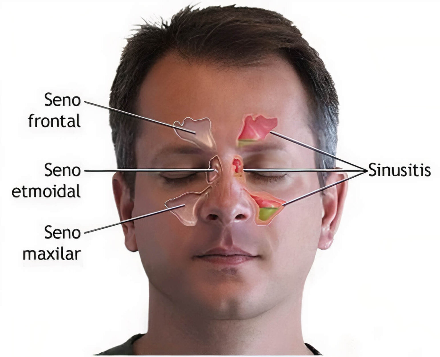 Dolor de oídos relacionado con la sinusitis - Info acúfenos