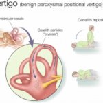 ¿Cuál es la causa del vértigo postural paroxístico benigno y existe ...